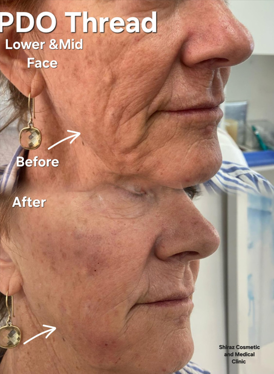 How Much Does a Thread Lift Cost in Australia?