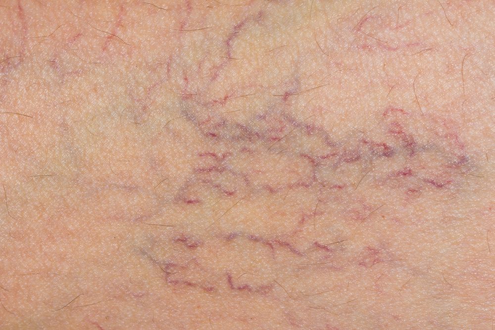 Sclerotherapy Injection Solution for Varicose Veins