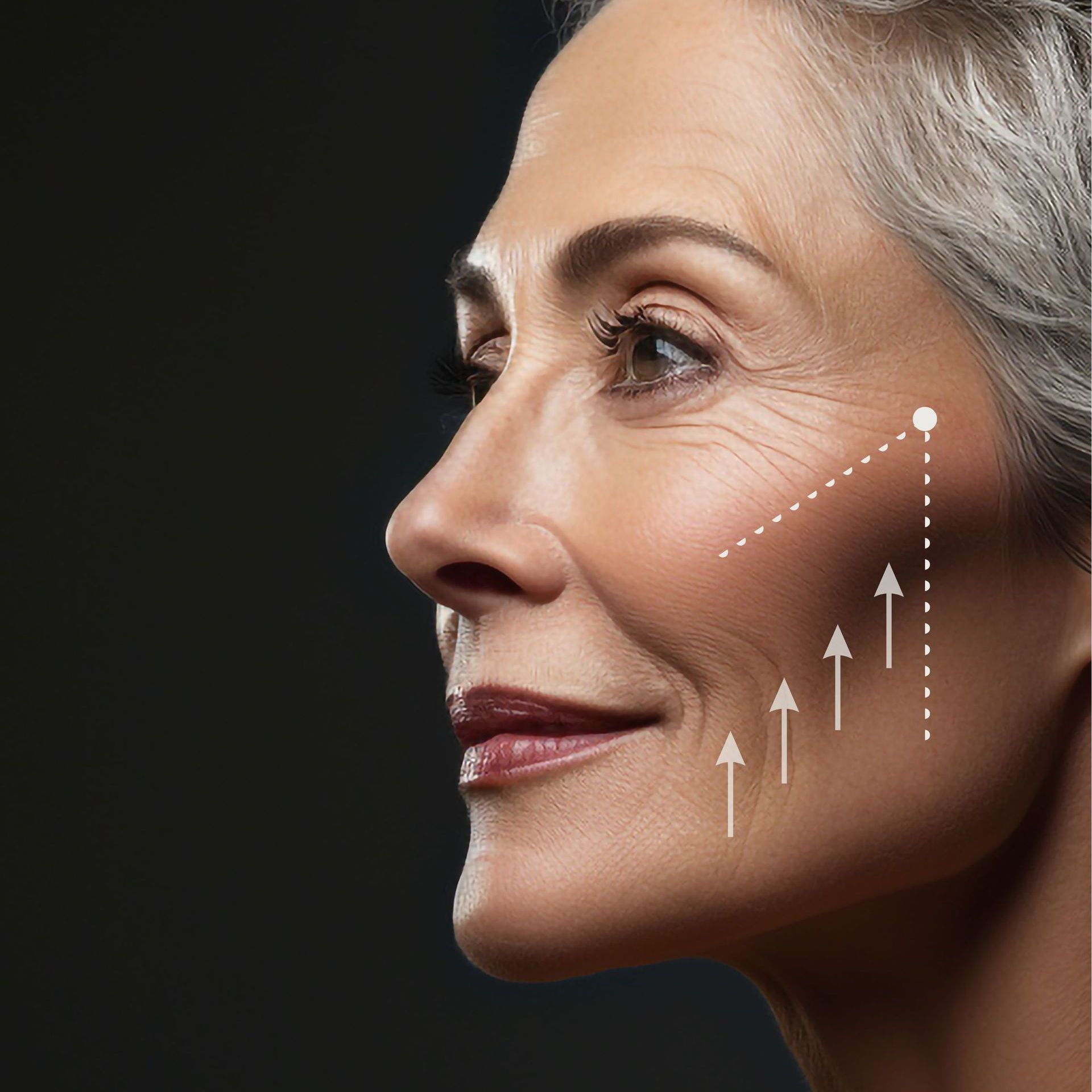 Profhilo Structura | Shiraz Cosmetic and Medical Clinic